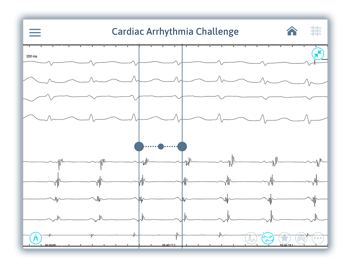Cardiac Arrhythmia Challenge - CorXL | Advanced cardiac device training